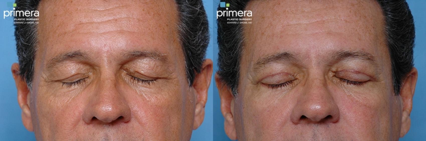 Blepharoplasty Before And After Pictures Case 12 Orlando Florida