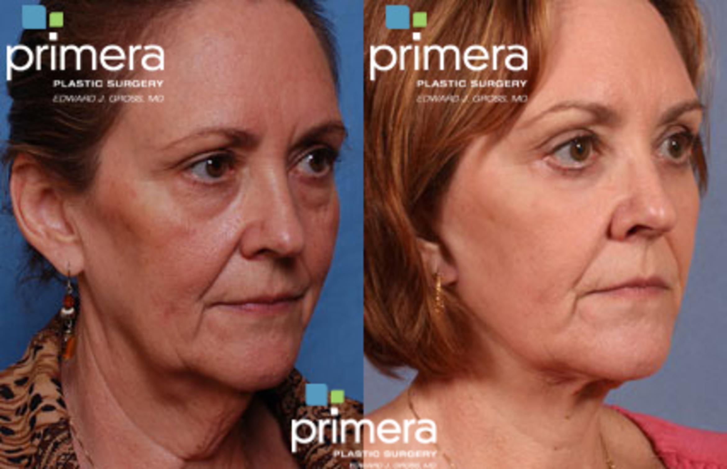 Chemical peel and facelift orlando