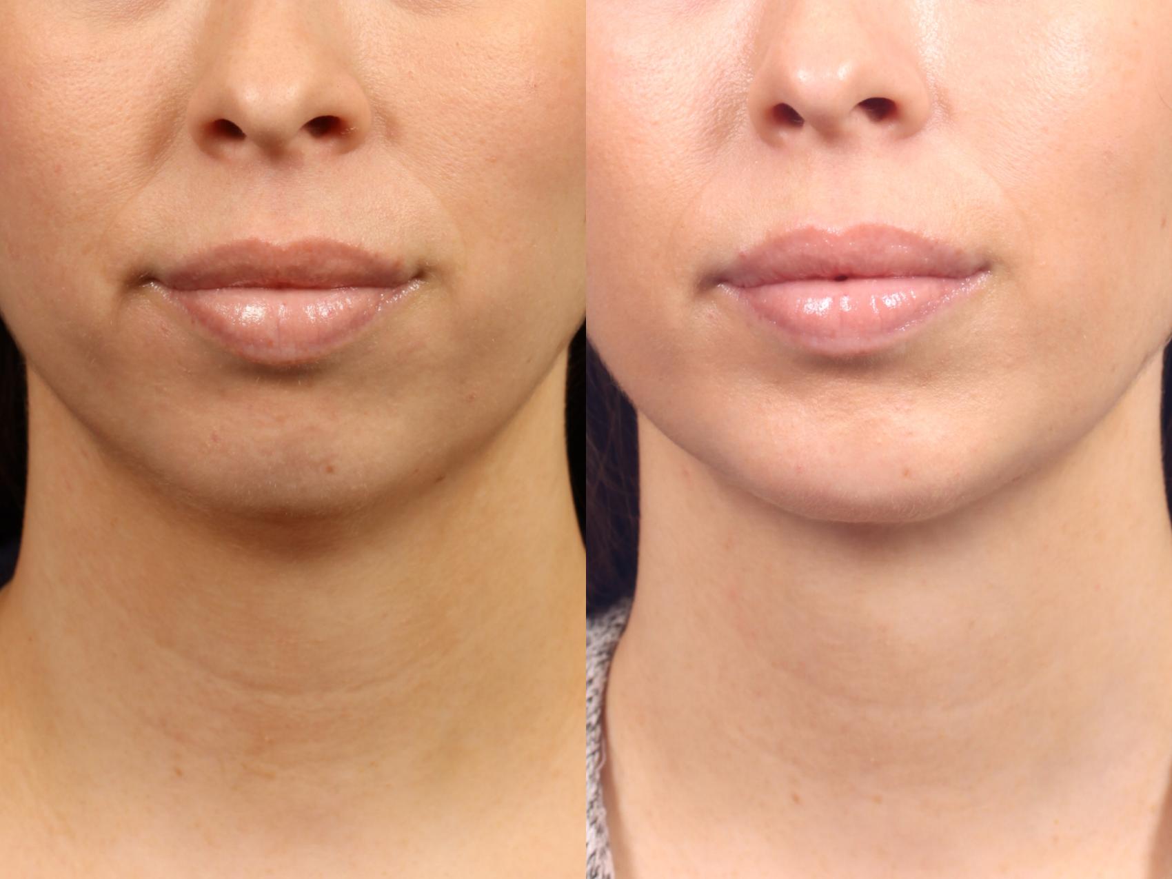 Chin & Cheek Implant Before and After Pictures Case 584 | Orlando ...