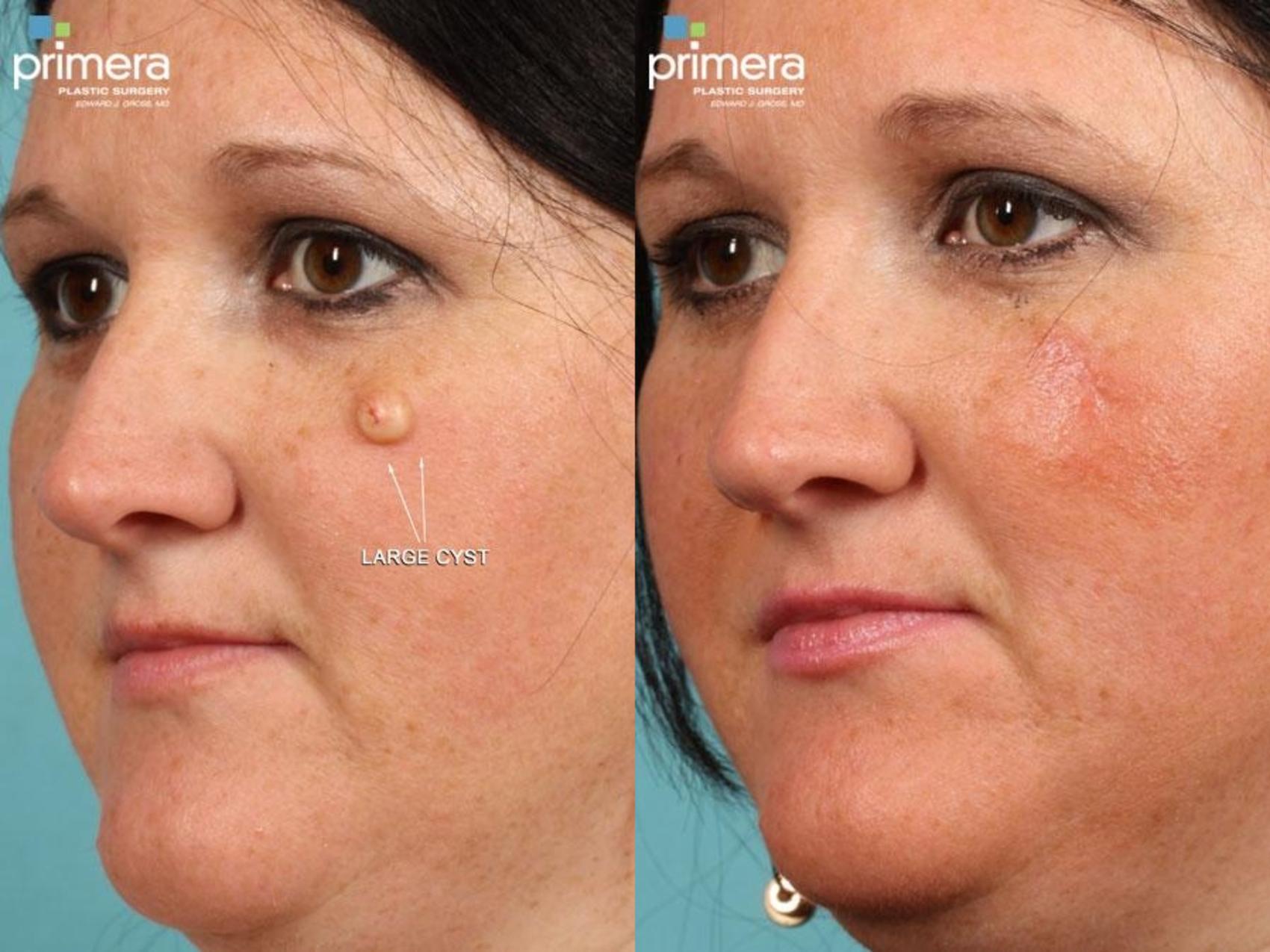 Sebaceous Cyst Removal On Face Infoupdate