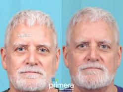 Lipoma Removal | Primera Plastic Surgery | Orlando, FL