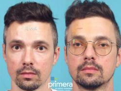 Lipoma Removal | Primera Plastic Surgery | Orlando, FL