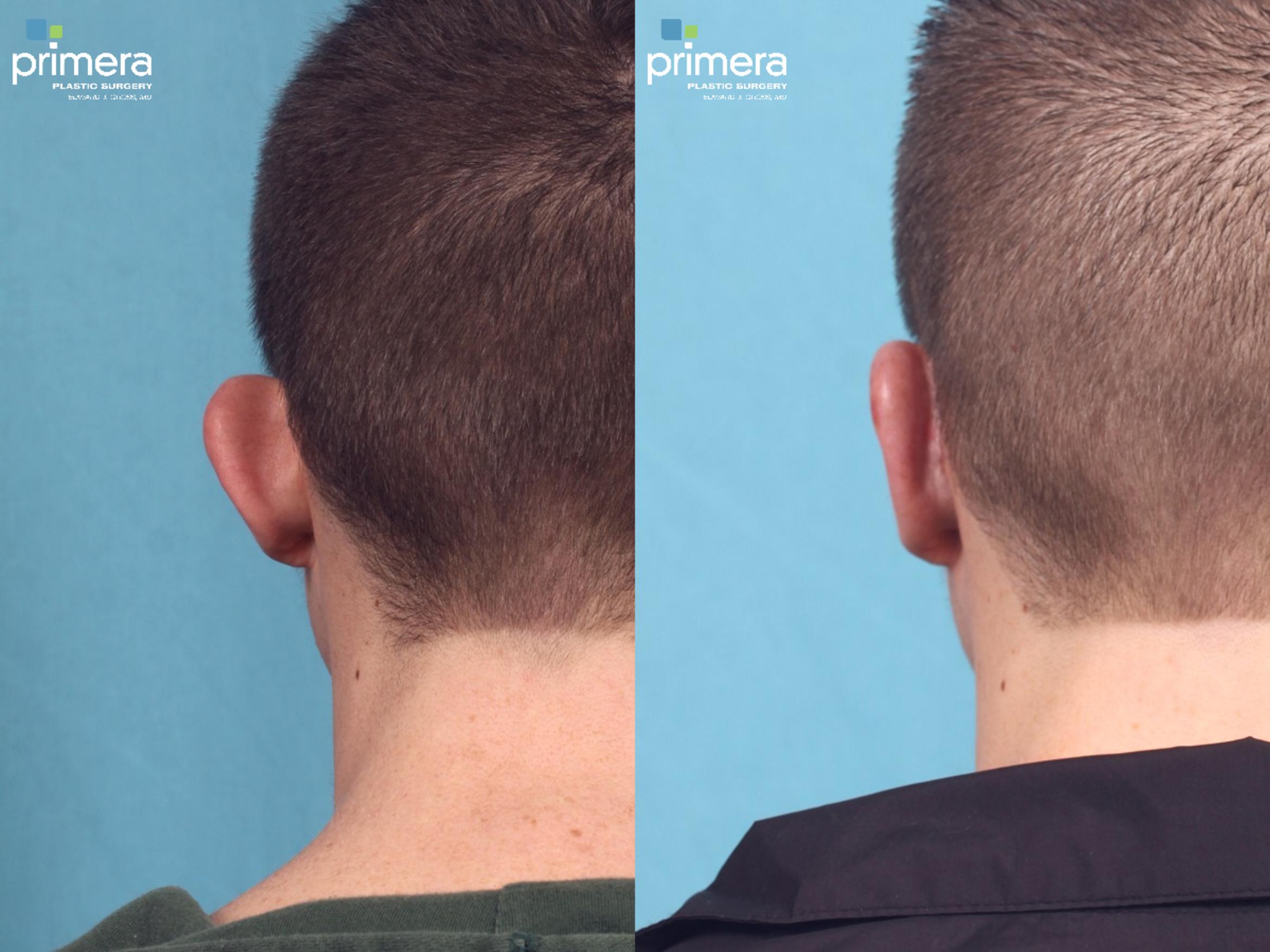 Otoplasty- Orlando- Florida