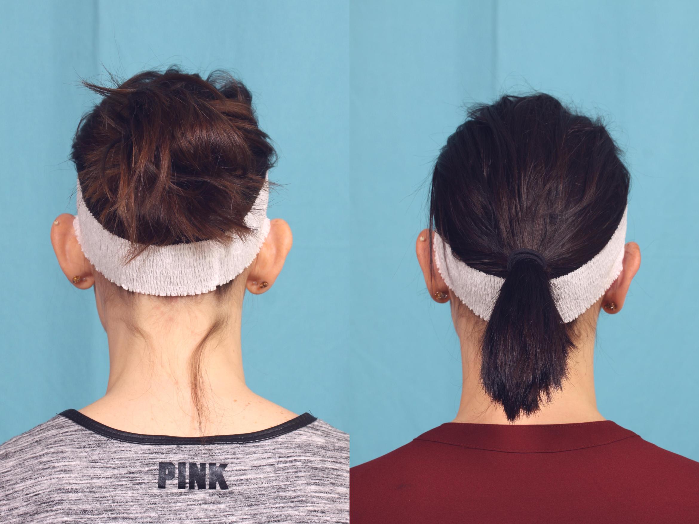 Ear Surgery (Otoplasty) Before & After Photos Patient 517 | Orlando ...