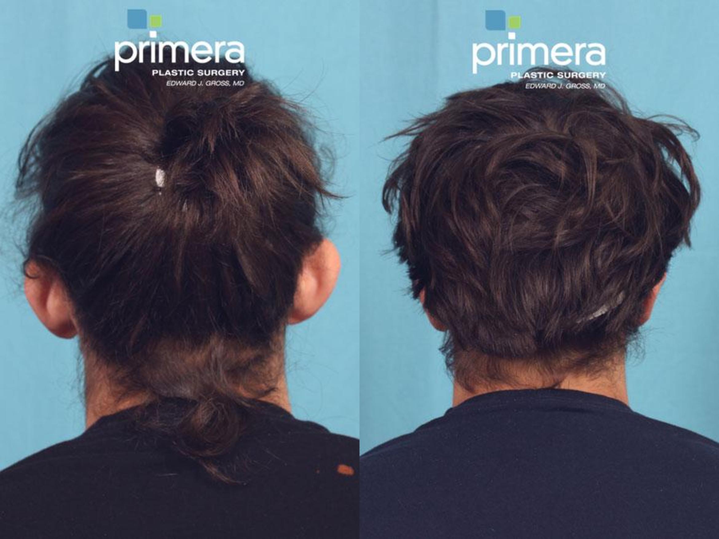 Ear Surgery (Otoplasty) Before and After Pictures Case 519 | Orlando ...