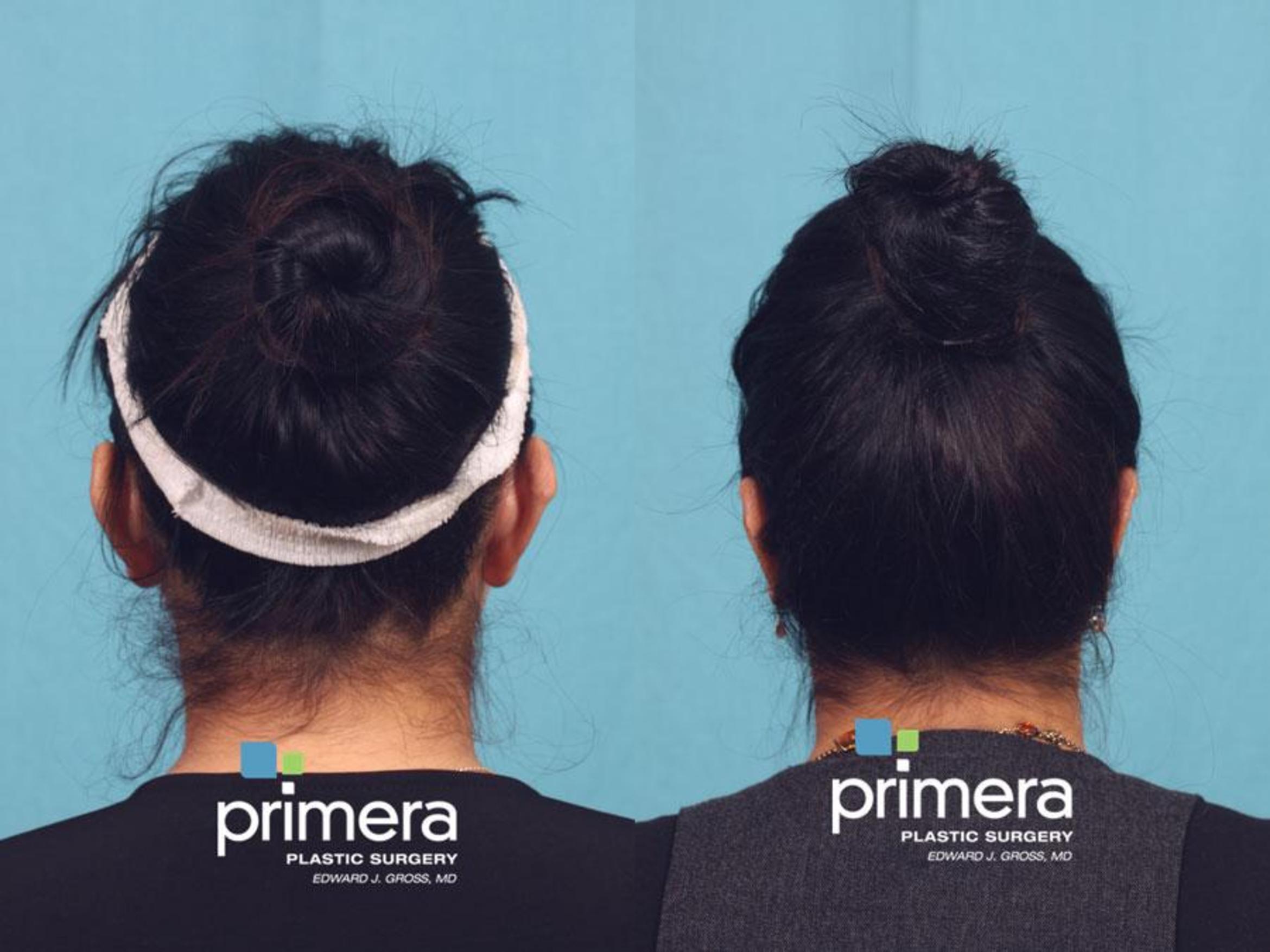 Ear Surgery (Otoplasty) Before and After Pictures Case 551 | Orlando ...