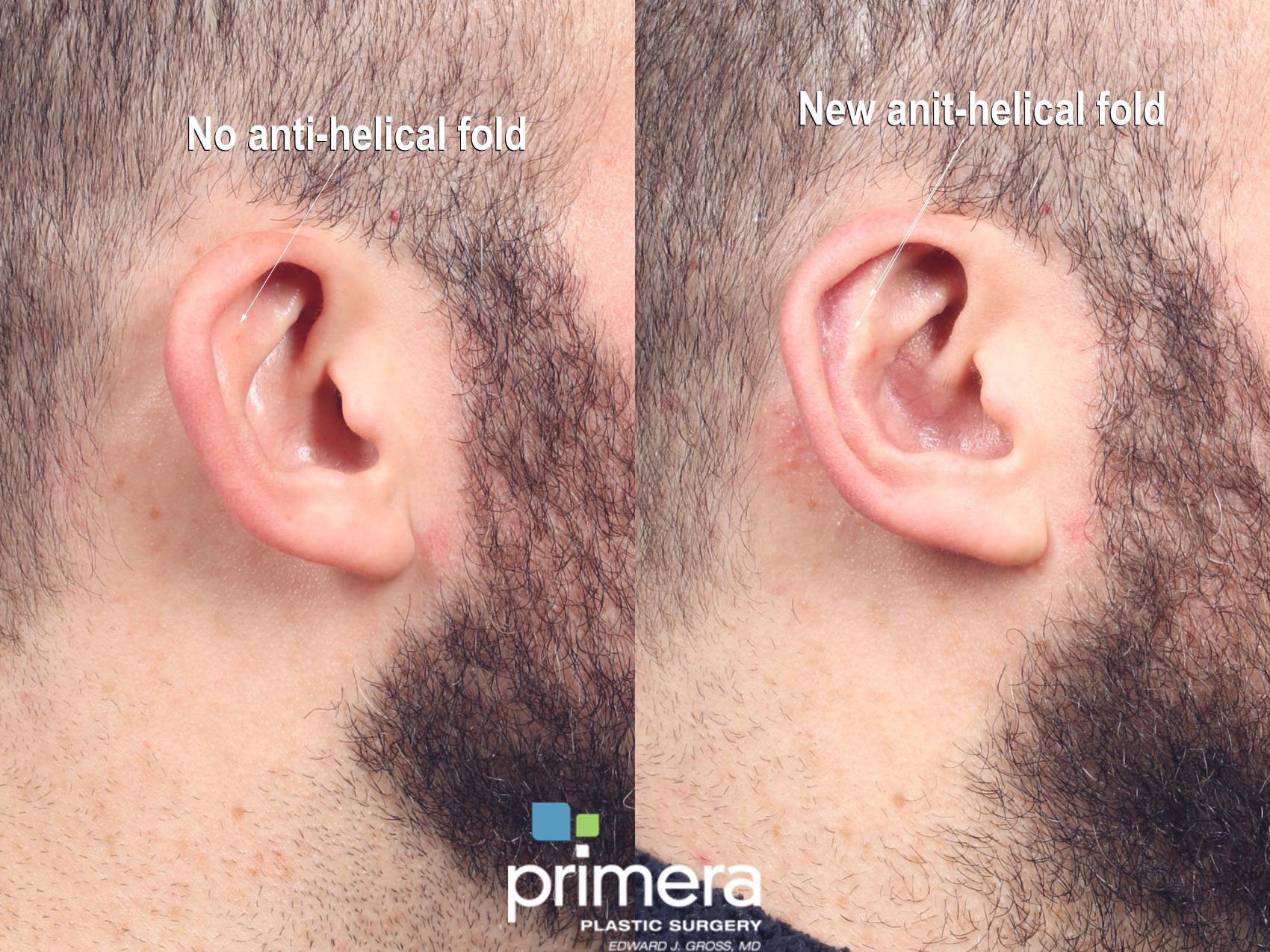 Ear Surgery (Otoplasty) Before and After Pictures Case 996 | Orlando ...
