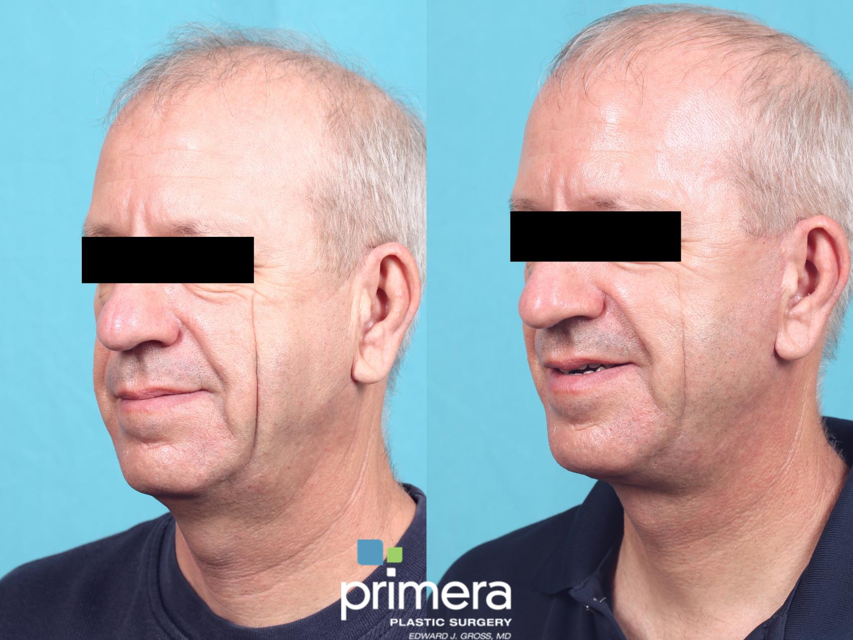 Facelift Before and After Pictures Case 669 | Orlando, Winter Park ...