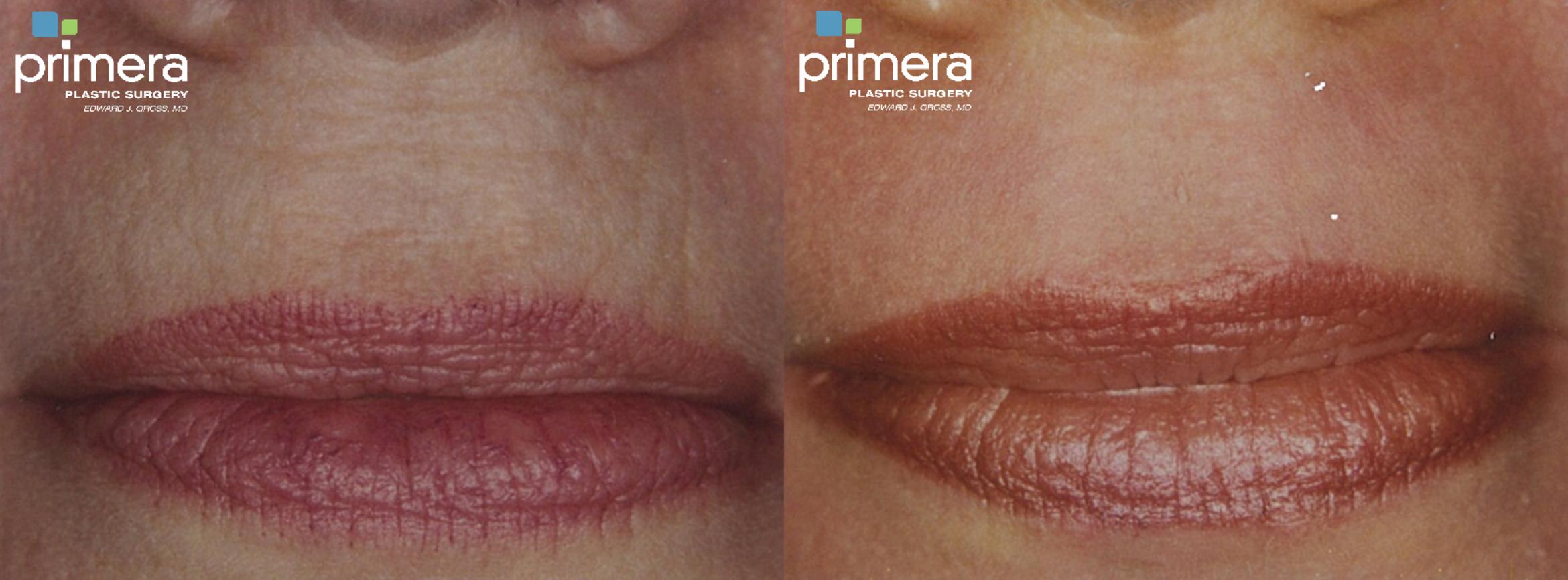 Laser Skin Resurfacing
