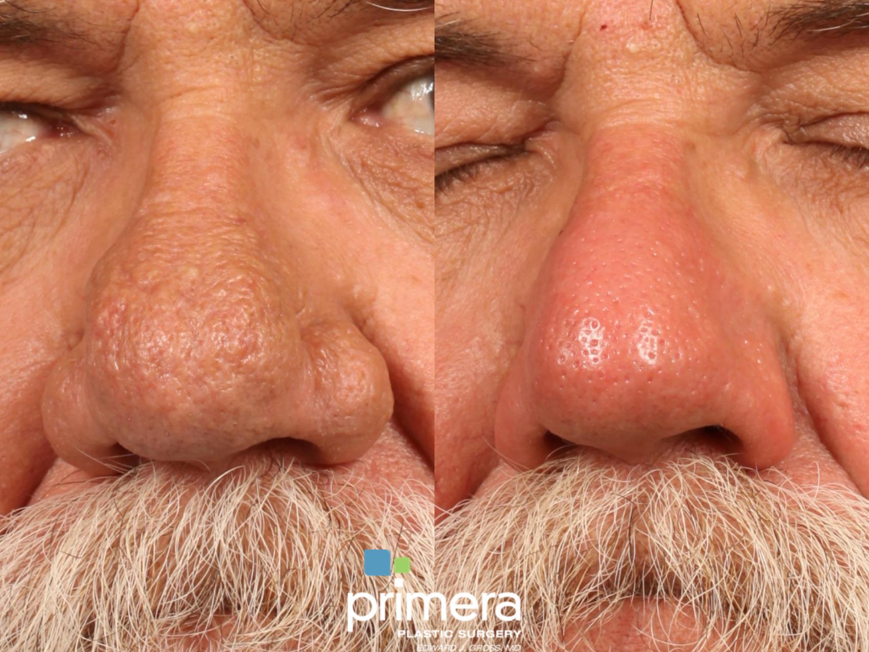 Laser Skin Resurfacing (DOT CO2) Before and After Pictures Case 503 ...