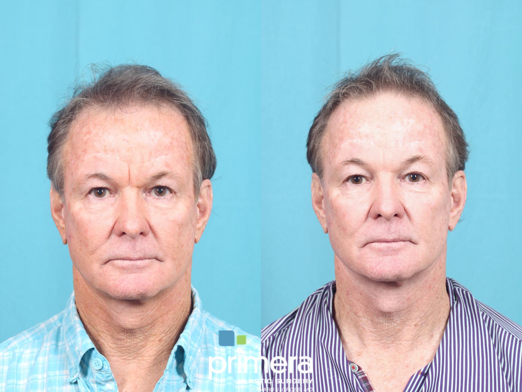 Laser Skin Resurfacing DOT CO2 Before And After Pictures Case 692 Laser Skin Resurfacing DOT CO2 Before And After Pictures Case 692