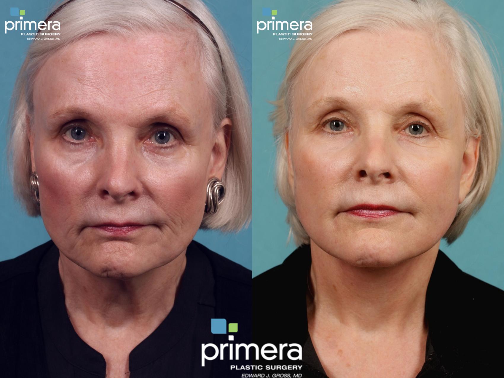 Mini Facelift Before and After Pictures Case 314 | Orlando, Winter Park ...