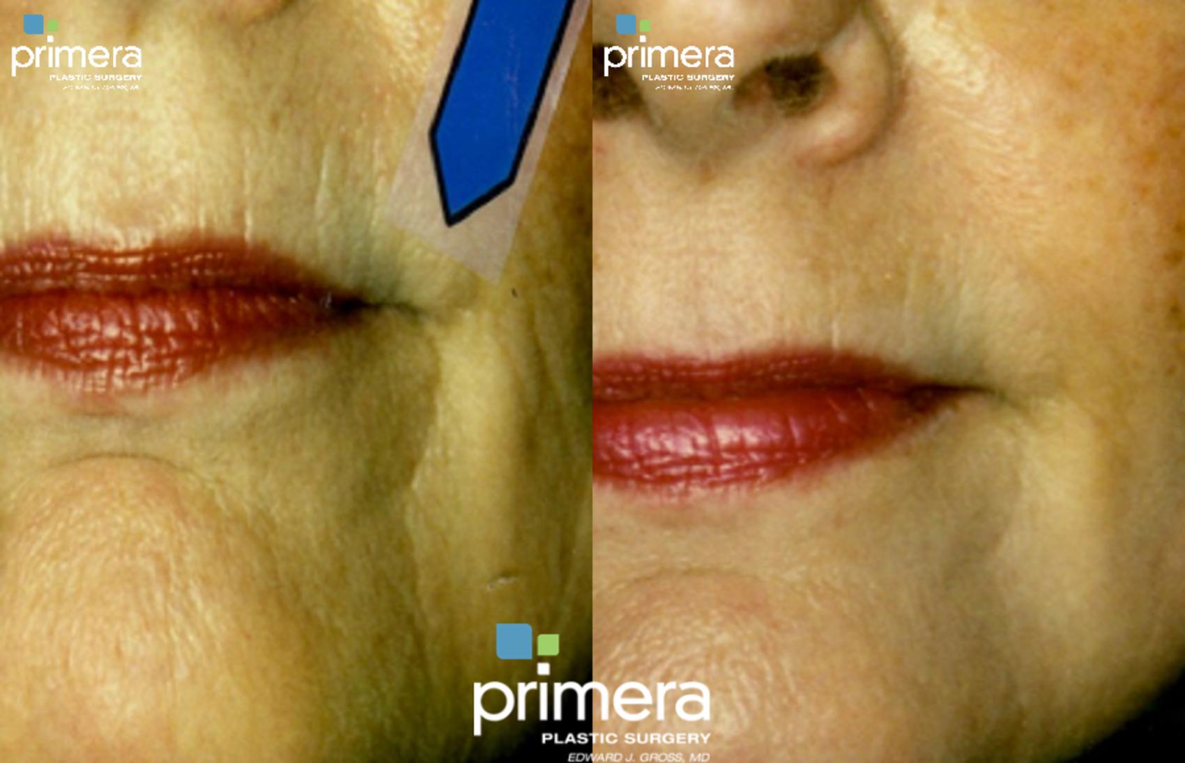 Mini Facelift Before and After Pictures Case 314 | Orlando, Winter Park ...