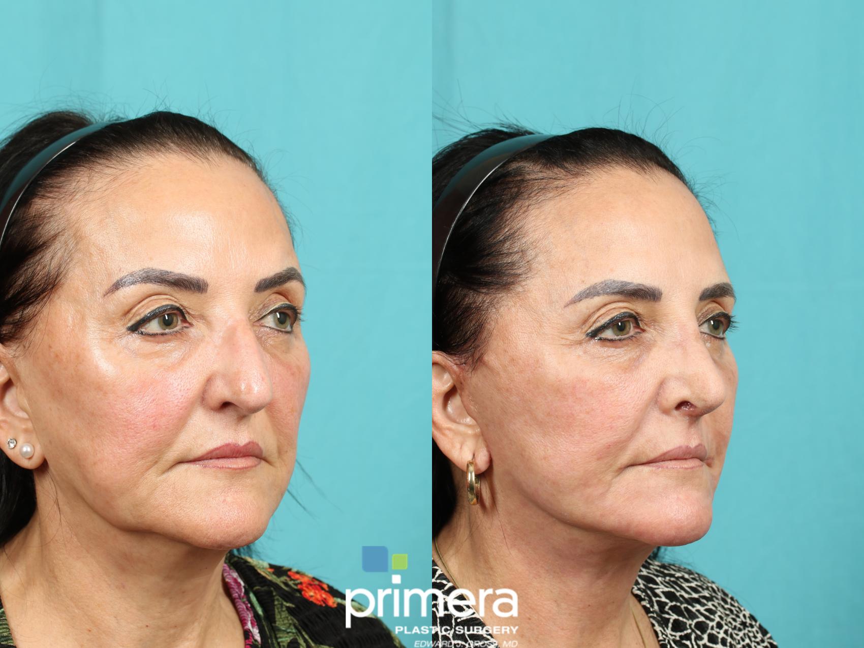 Mini Facelift Before and After Pictures Case 772 | Orlando, Winter Park ...