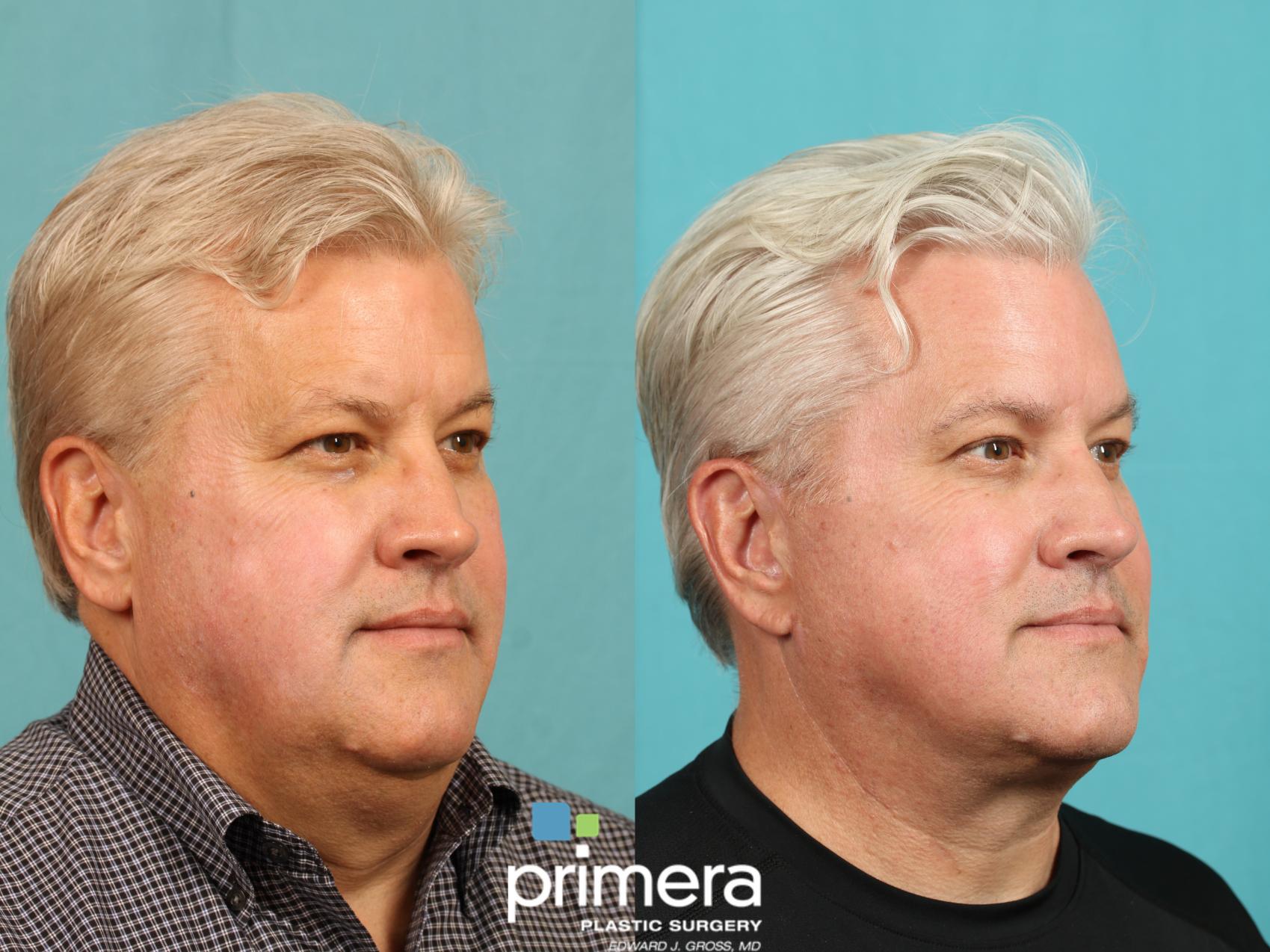 Mini Facelift Before and After Pictures Case 773 | Orlando, Winter Park ...