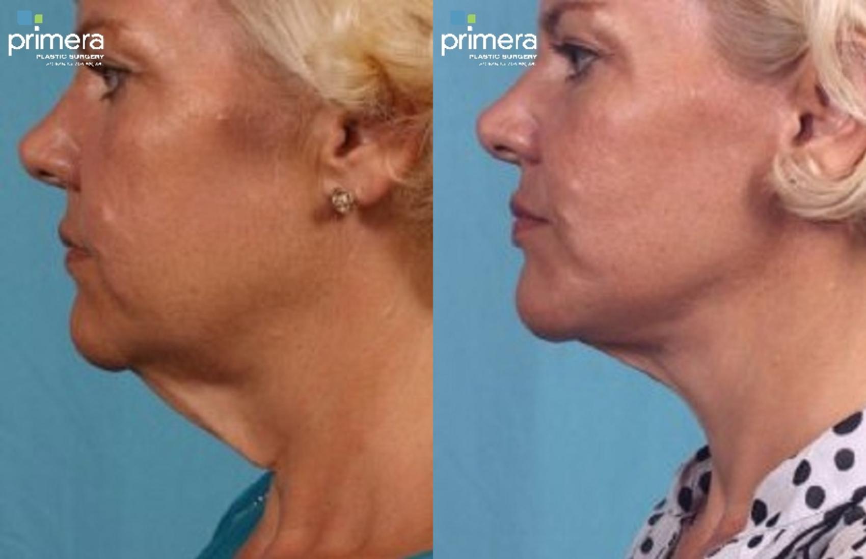 Neck & Face Liposuction Before and After Pictures Case 126 | Orlando ...