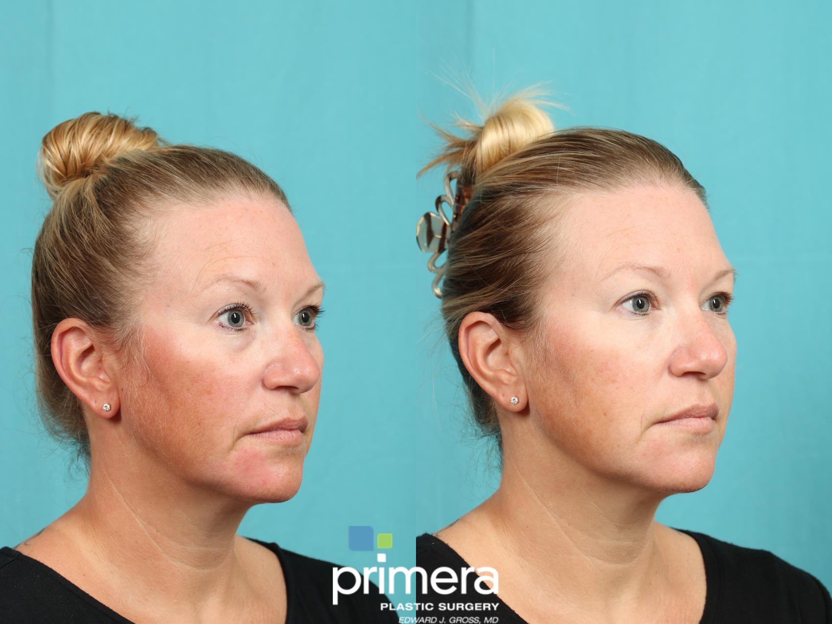 Restylane® Before and After Pictures Case 611 | Orlando, Winter Park ...