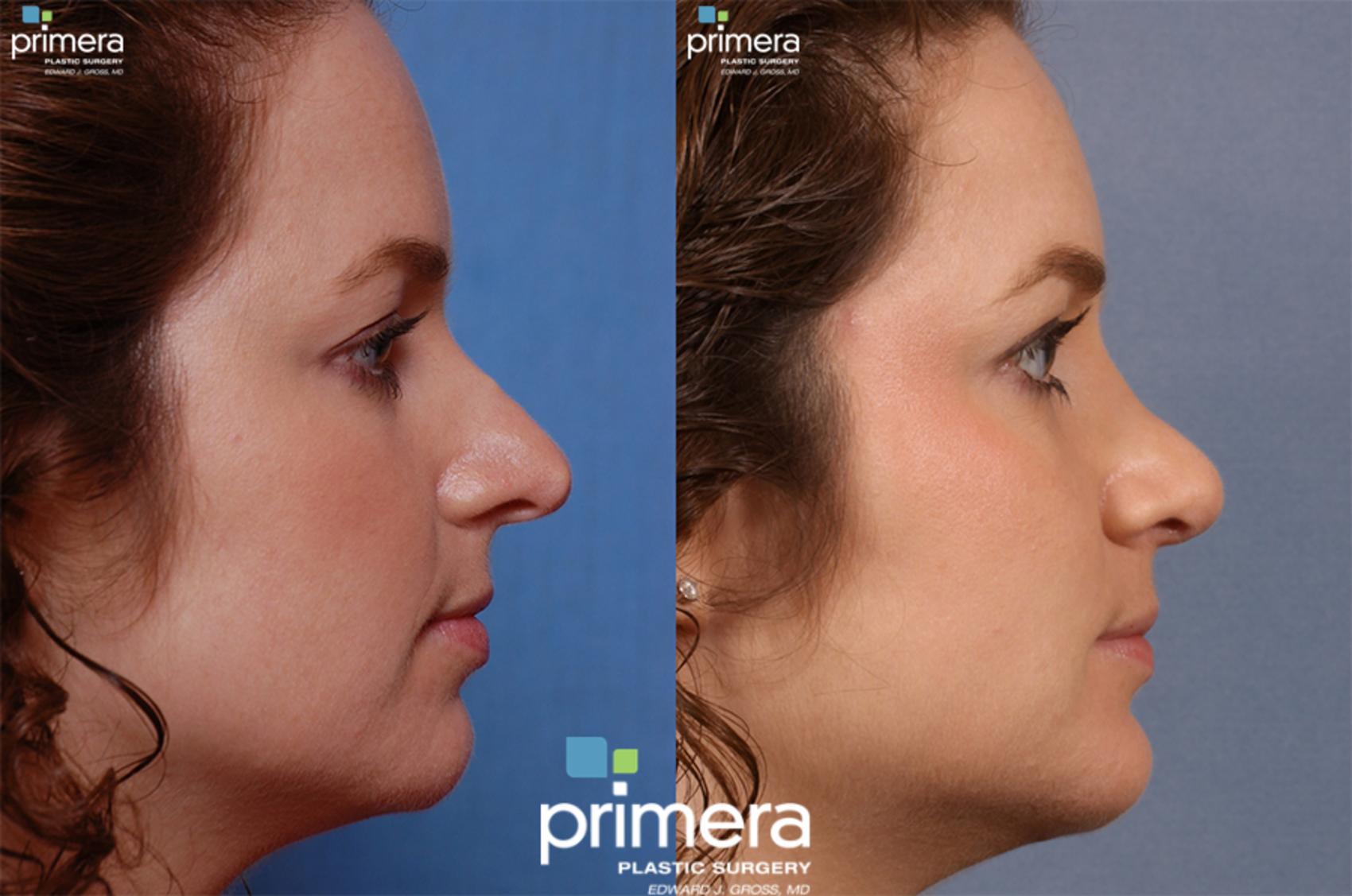 Revision Rhinoplasty Before and After Pictures Case 44 | Orlando ...