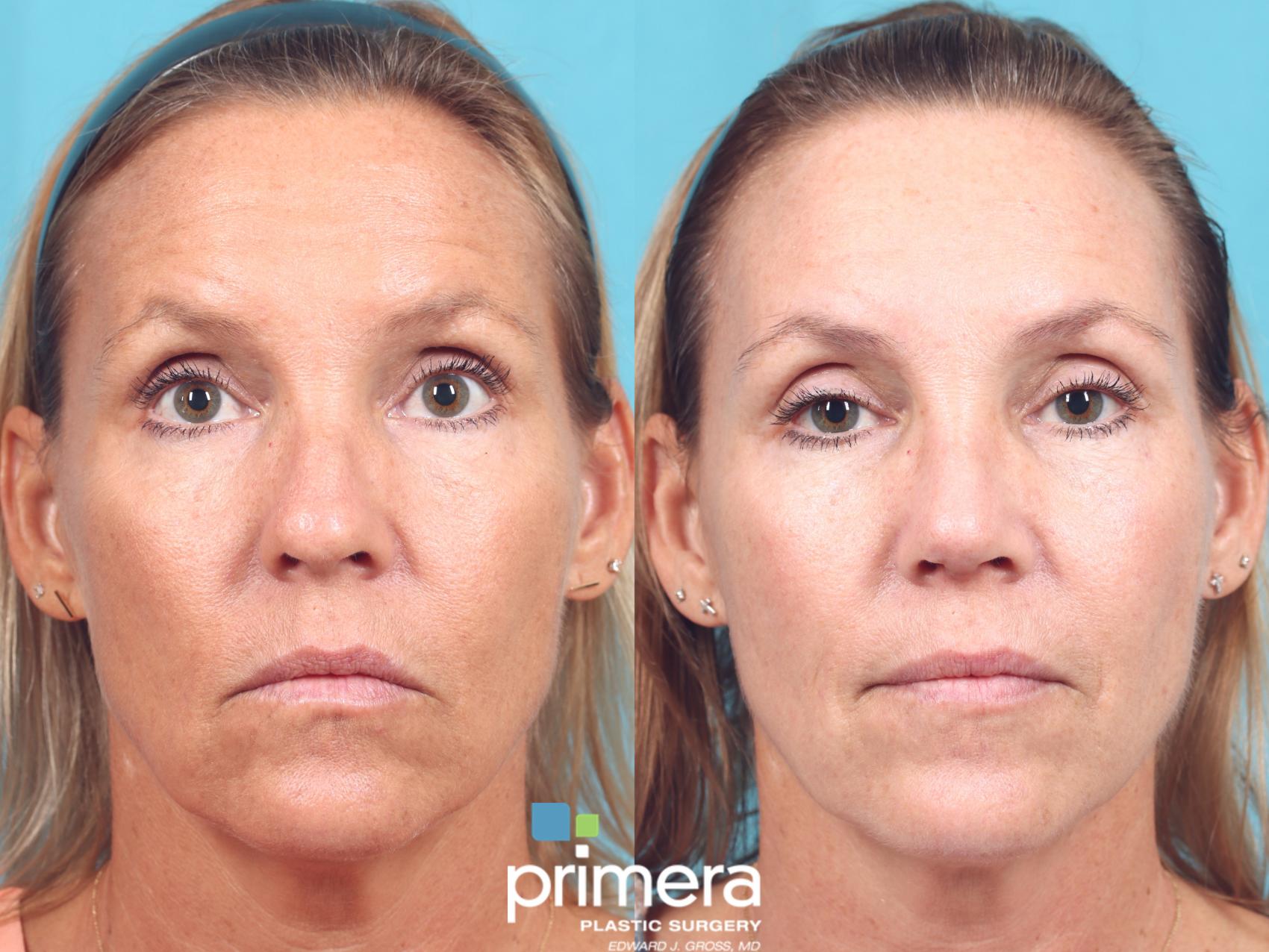 Revision Rhinoplasty Before and After Pictures Case 793 | Orlando ...