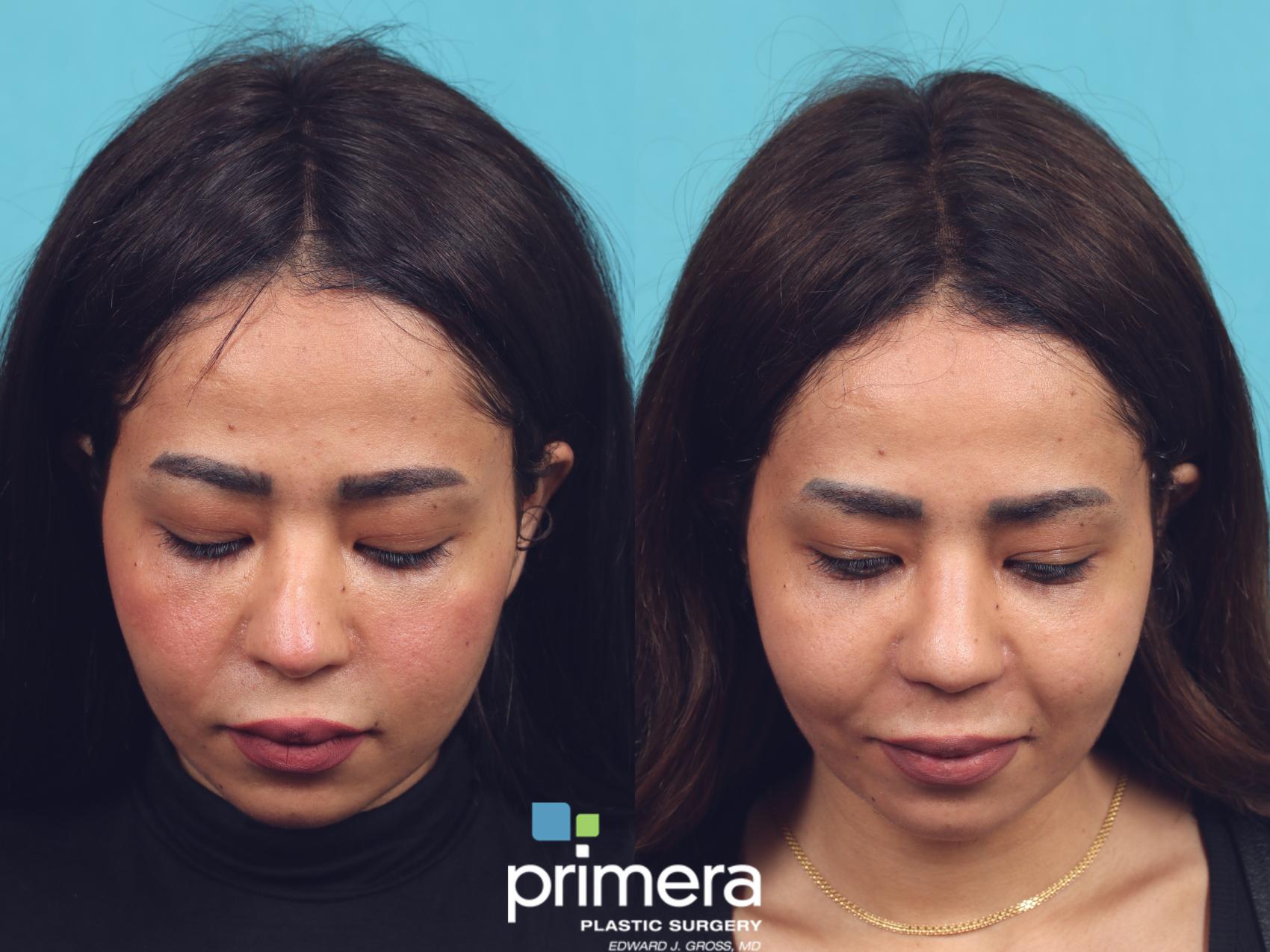 Revision Rhinoplasty Before and After Pictures Case 857 | Orlando ...