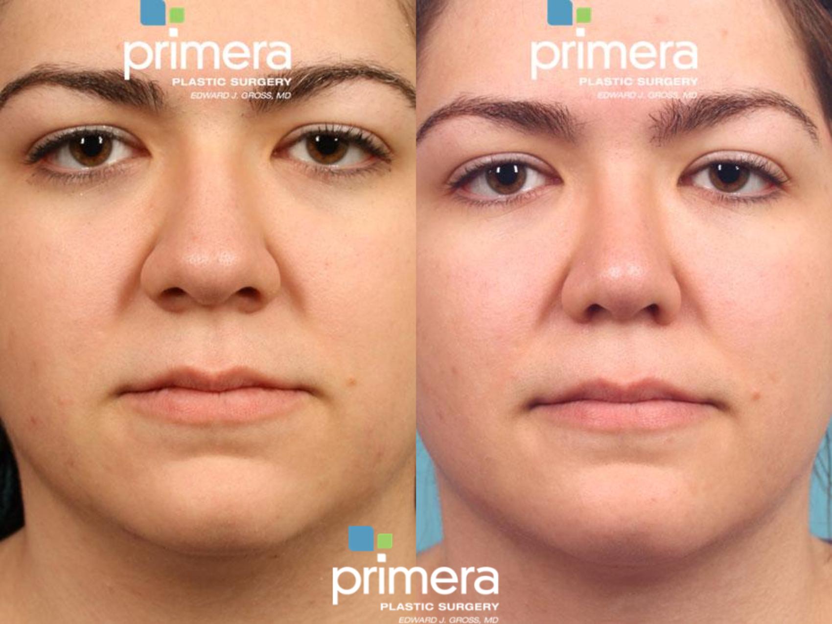 Rhinoplasty Before and After Pictures Case 579 | Orlando, Winter Park ...