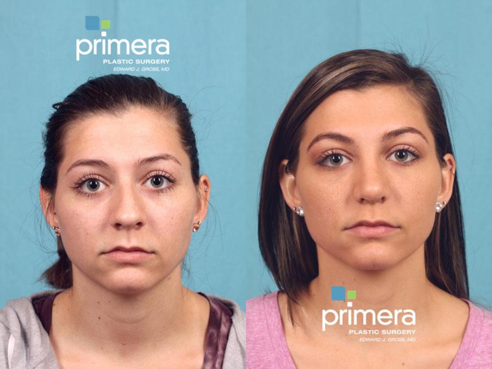 Rhinoplasty Before and After Pictures Case 580 | Orlando, Winter Park ...