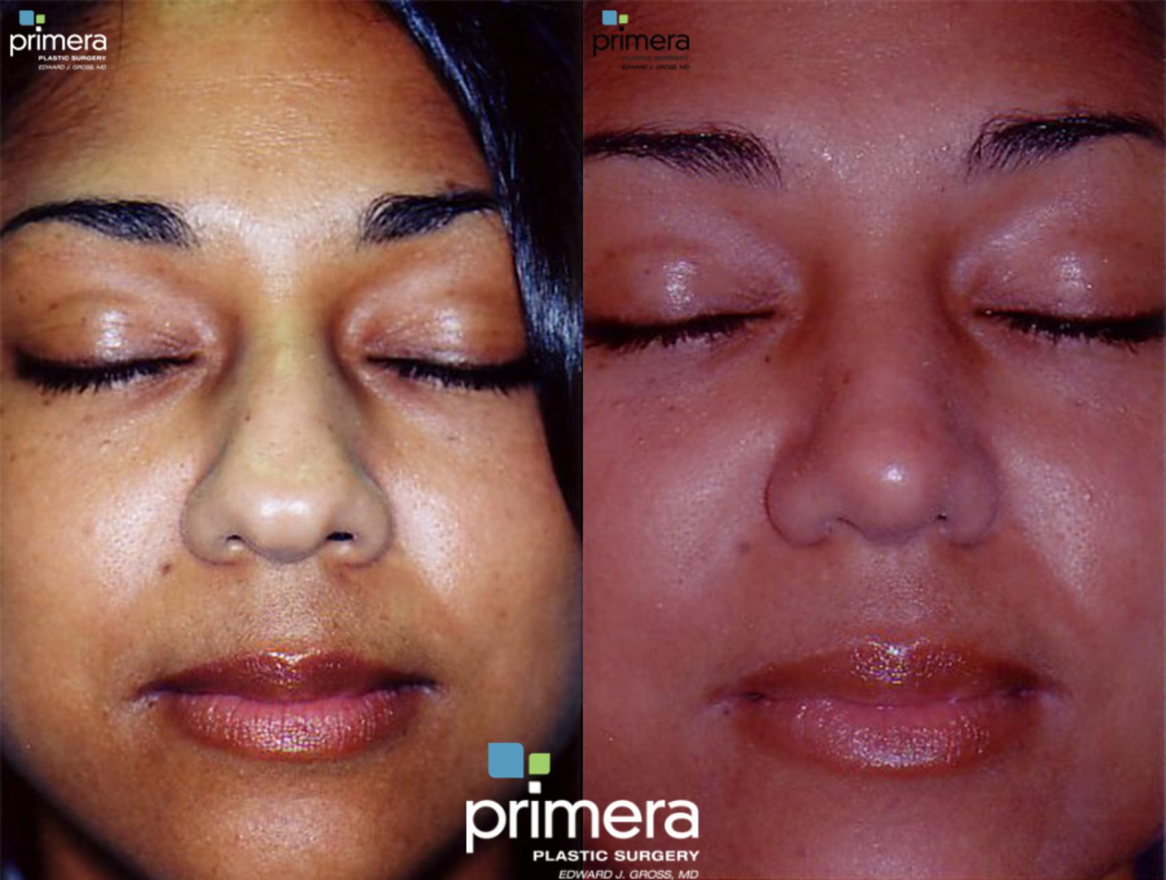 Rhinoplasty Before and After Pictures Case 60 | Orlando, Winter Park ...