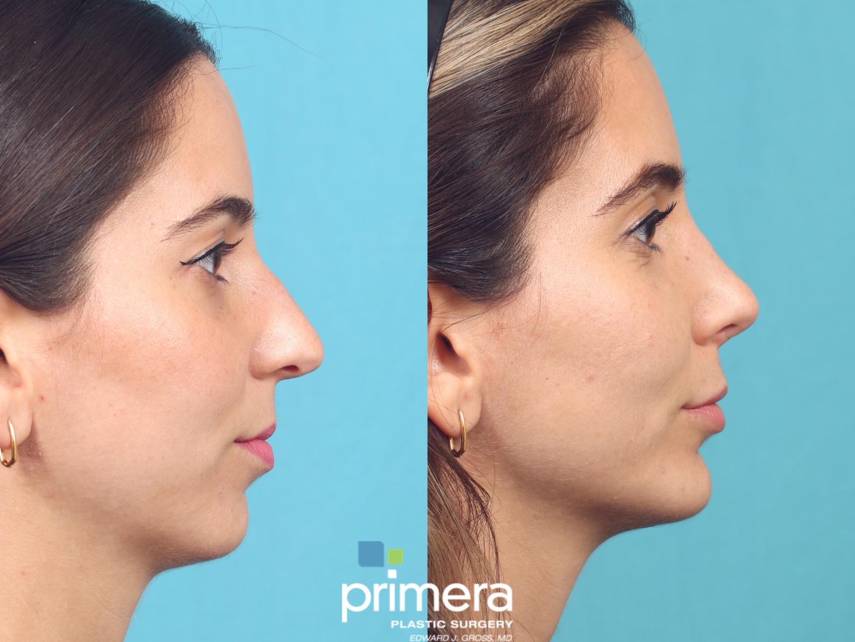 Rhinoplasty Before and After Pictures Case 871 | Orlando, Winter Park ...