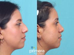 Rhinoplasty | Nose Job | Dr. Edward Gross | Primera Plastic Surgery ...