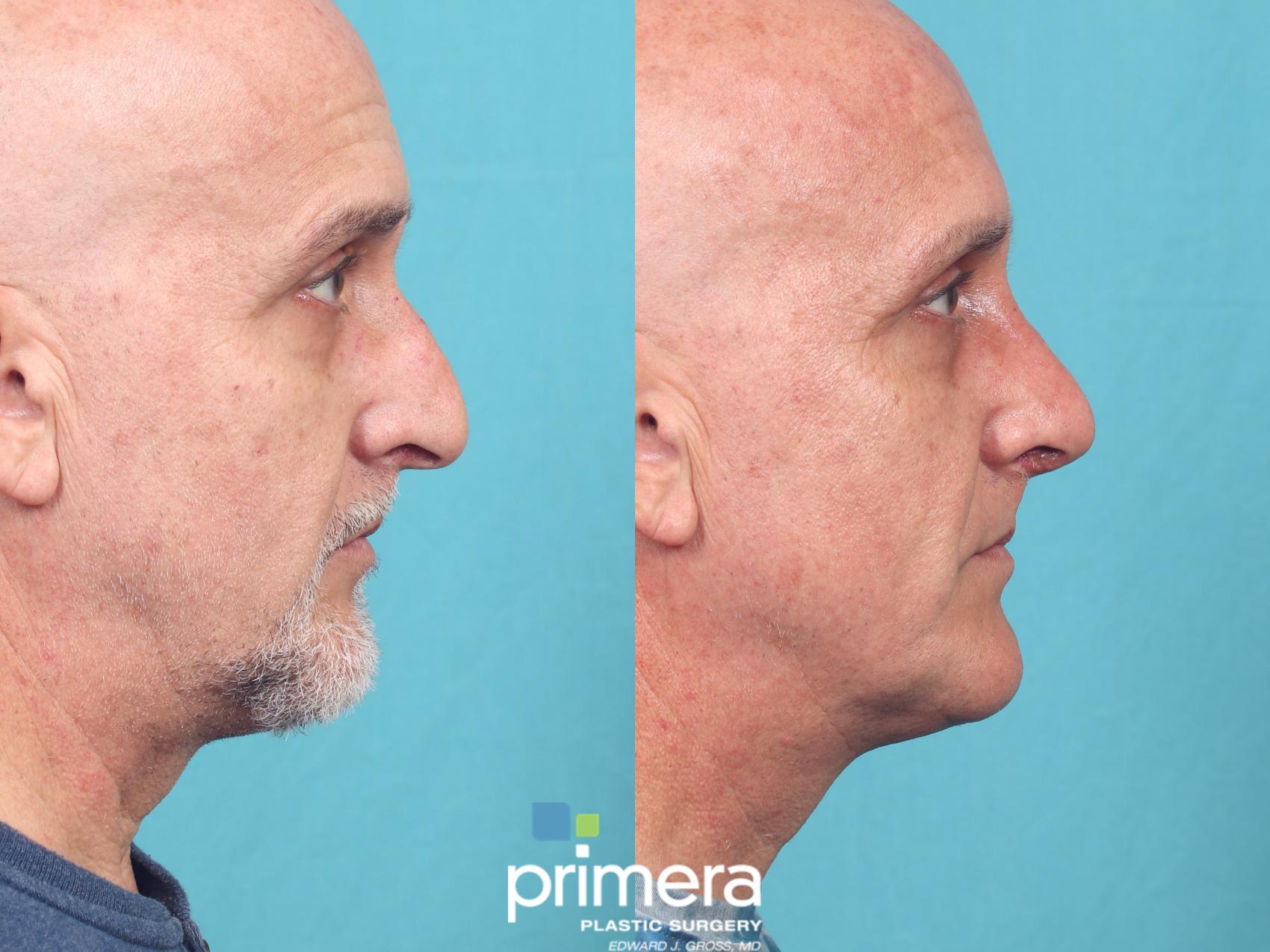 Rhinoplasty Before and After Pictures Case 899 | Orlando, Florida ...