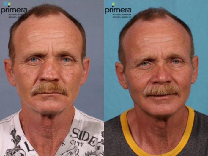 Surgery for Men Before and After Photo Gallery | Orlando, Florida ...